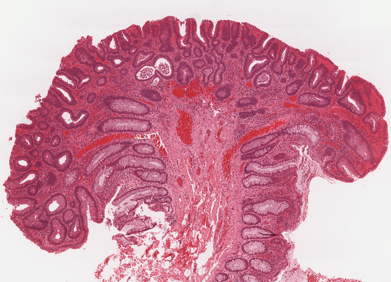 Duke Pathology - Genetic Disorders